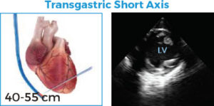 Why Hemodynamic Ultrasound? - Hemodynamic Ultrasound for ICU | ImaCor