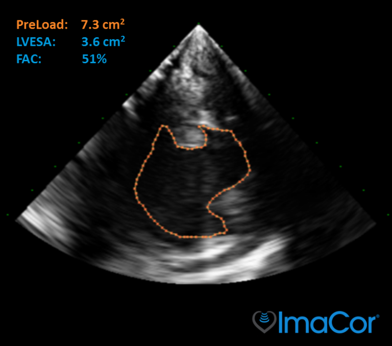 Hemodynamic Ultrasound for ICU | Heart Ultrasound Monitoring | ImaCor